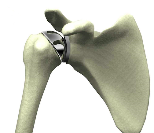 Shoulder Device Saves Arm Function & Career for Self-Described ...